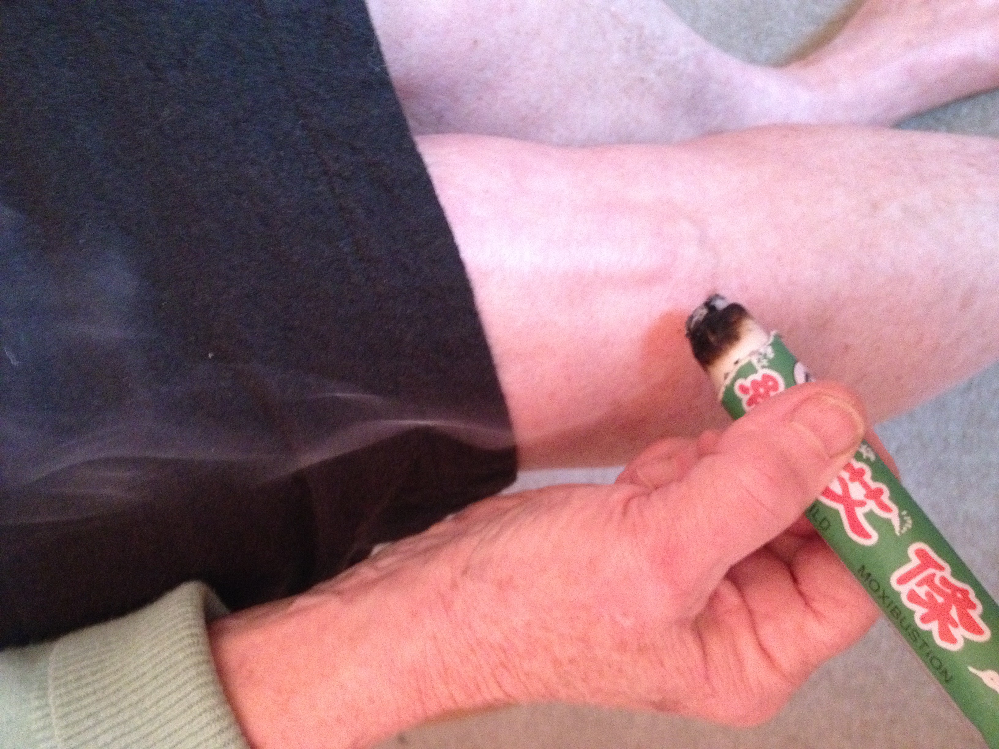 Boosting our immune system with Moxa | Acupuncture in Bristol